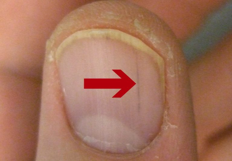 15 Health WARNINGS Your Fingernails Are Sending